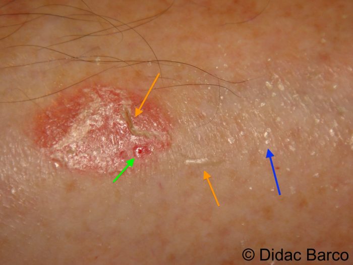 Psoriasis: manifestaciones cutáneas, del cuero cabelludo y de las uñas ...
