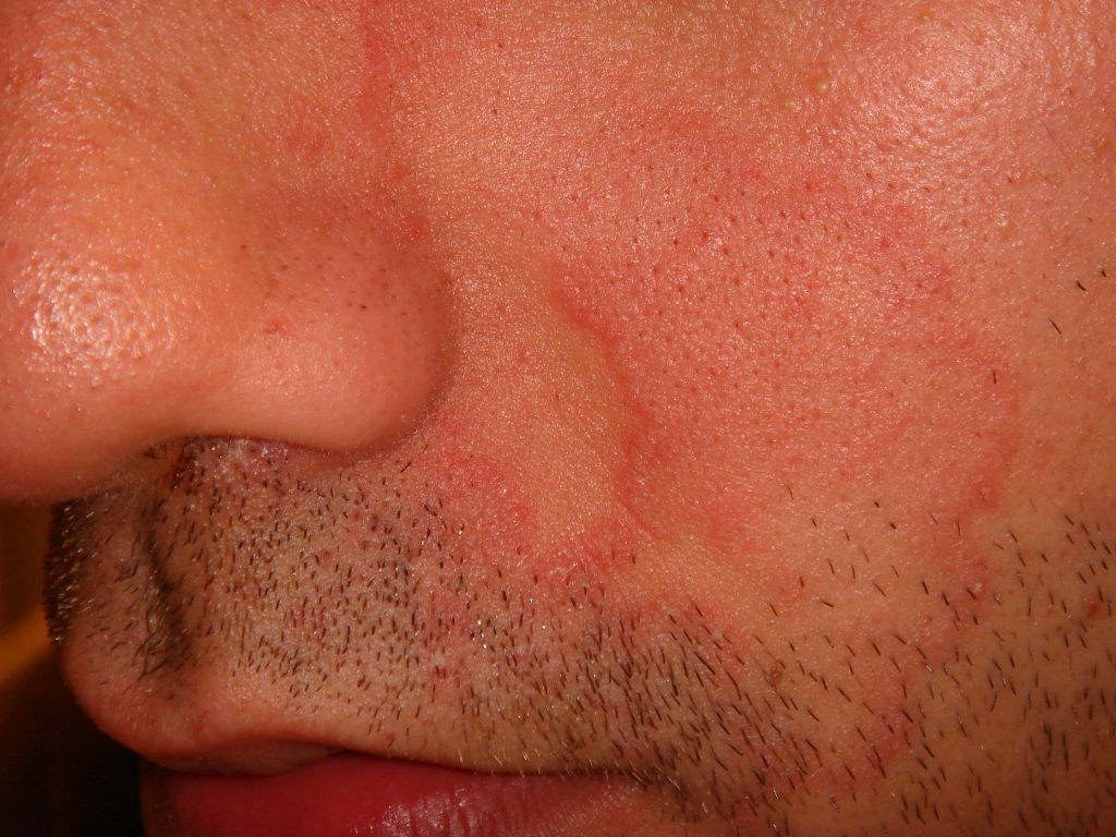 Dermatitis seborreica - Didac Barco