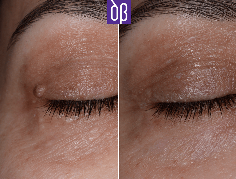 Tratamiento de siringomas con láser - Didac Barco