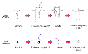 Tratamiento de cicatrices de acné con ‘punch’ - Didac Barco