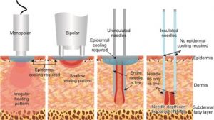 Cicatrices de acné con radiofrecuencia de agujas